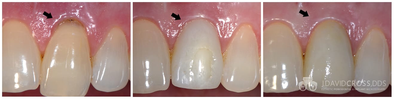 Springfield Smile Technique Before & After Photos